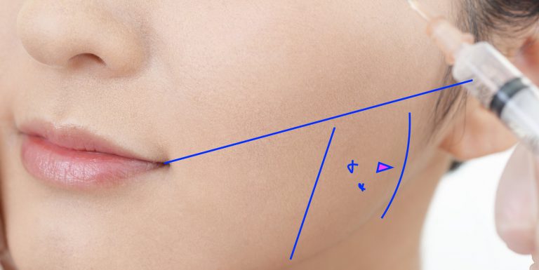 Masseter Botox for Dentists