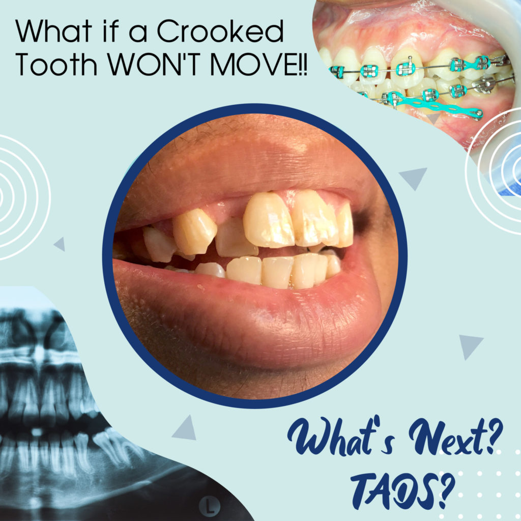 What if a Crooked Tooth WON'T MOVE!! What's Next? TADS?