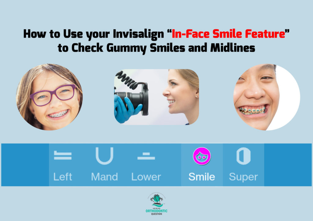 What You Need to Know About the Invisalign In-Face Smile Feature