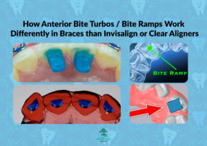 How Do Anterior Bite Turbos Work Differently in Braces or Clear ...