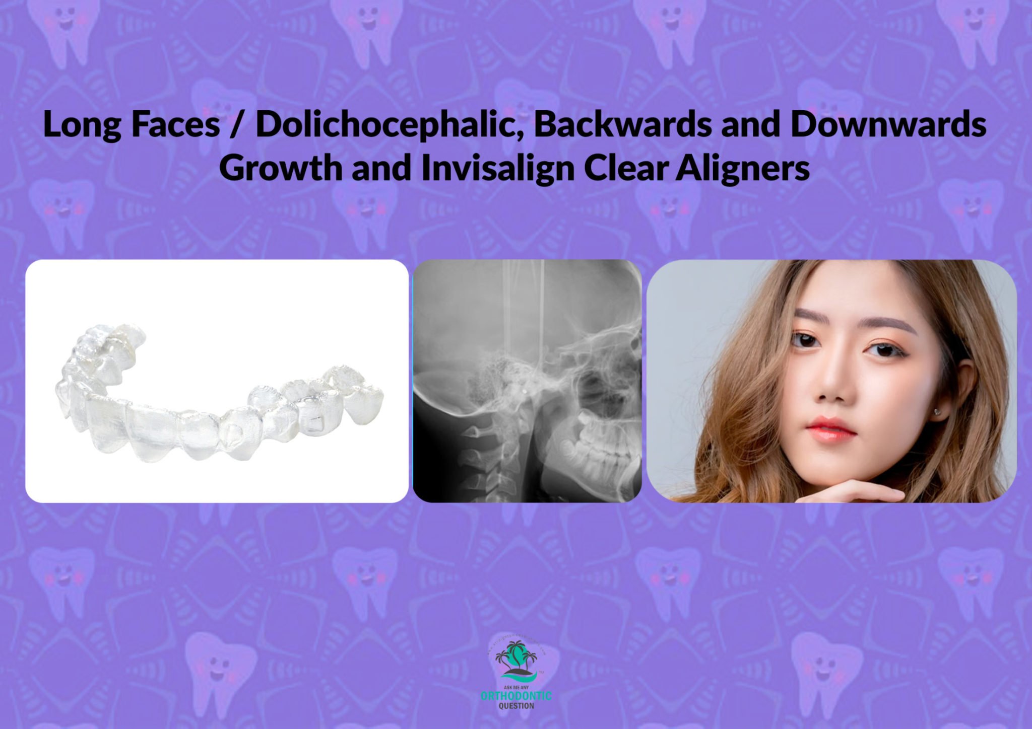 Long, Dolichocephalic Faces with Backwards and Downwards Growth and ...