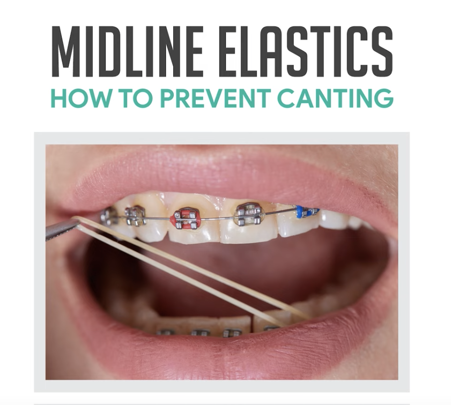 Midline Elastics: Preventing Canting
