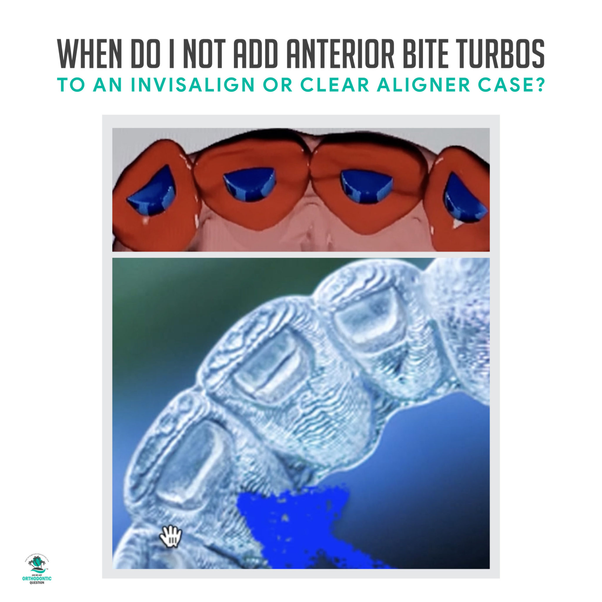 When Anterior Bite Turbos Don’t Work with Clear Aligner Cases