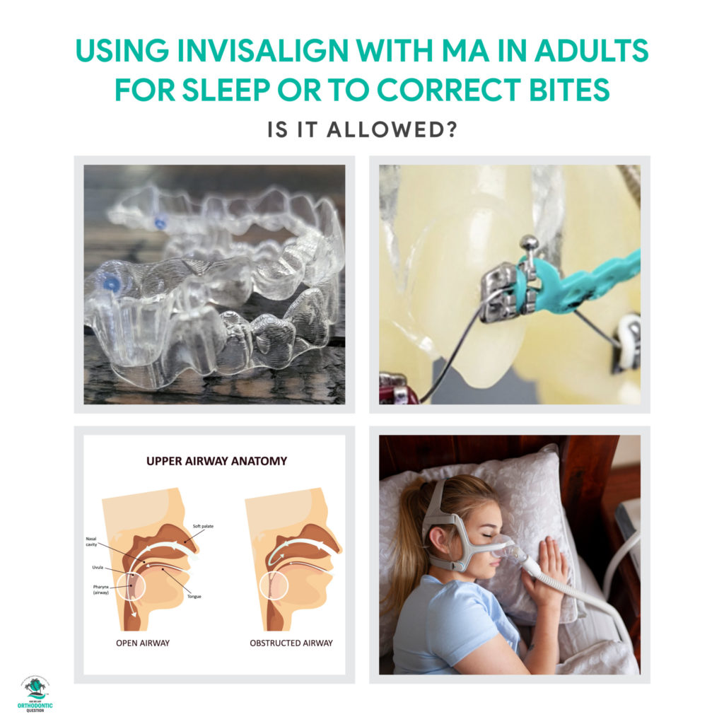 Using Invisalign with MA in Adults to Correct Bites for Sleep and Airway