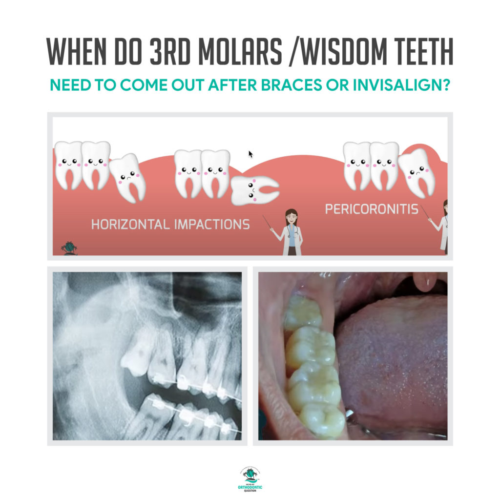 Do 3rd Molars or Wisdom Teeth need to come out after Braces or Invisalign?
