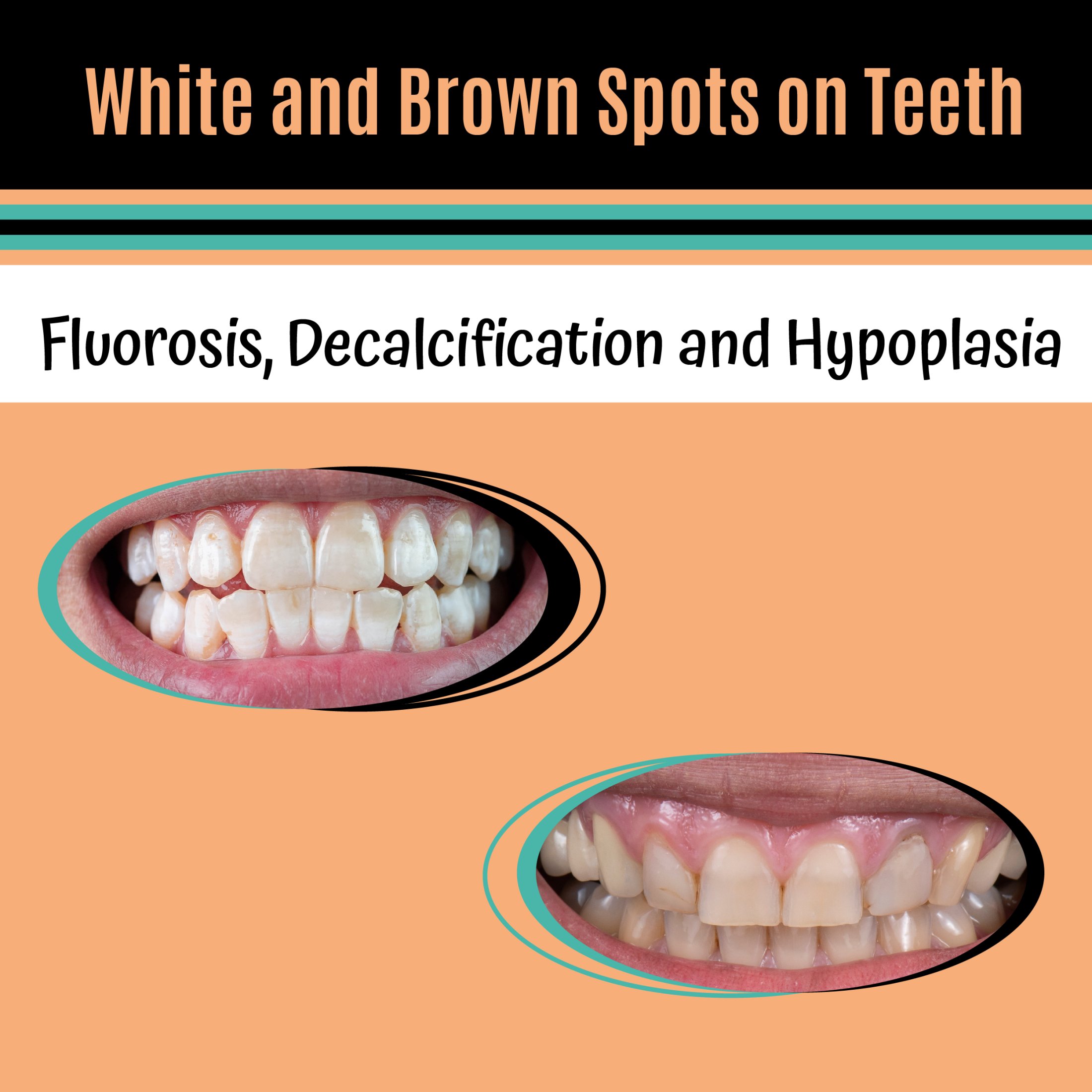 White and Brown Spots on Teeth: Fluorosis, Decalcification, and Hypoplasia