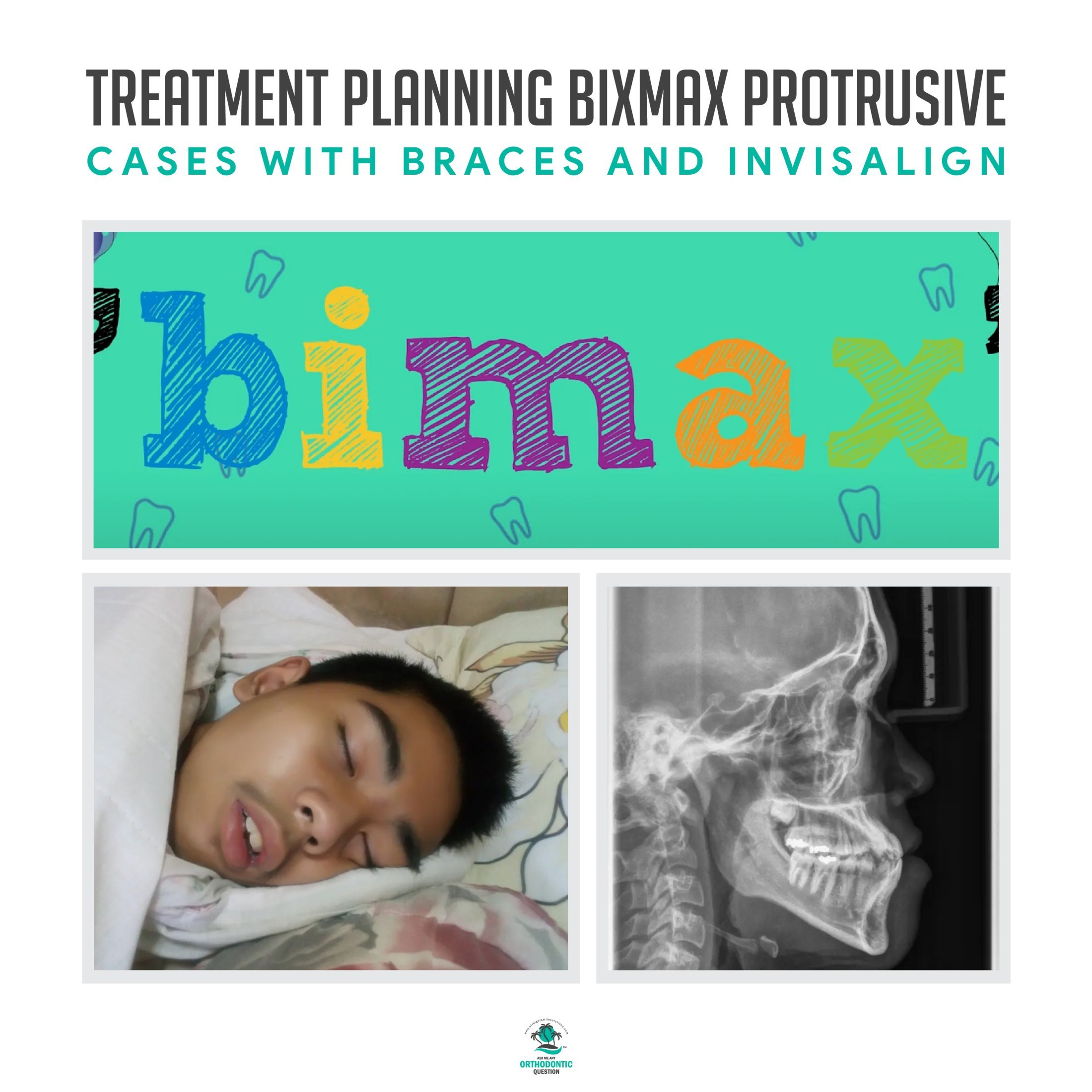 Bimax Protrusive Mechanics
