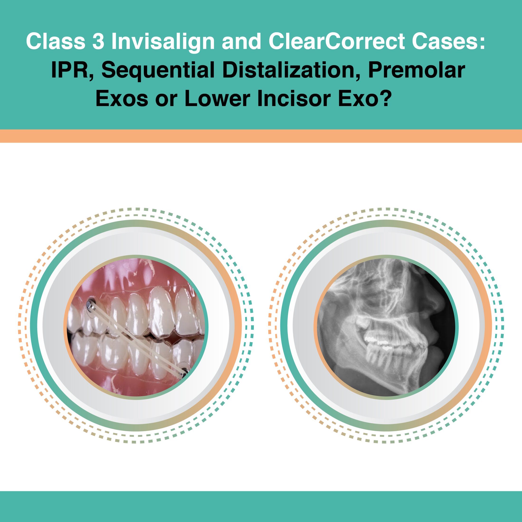 Class 3 Aligner Treatment Plans: IPR, Premolar Exos, Lower Incisor Exo ...
