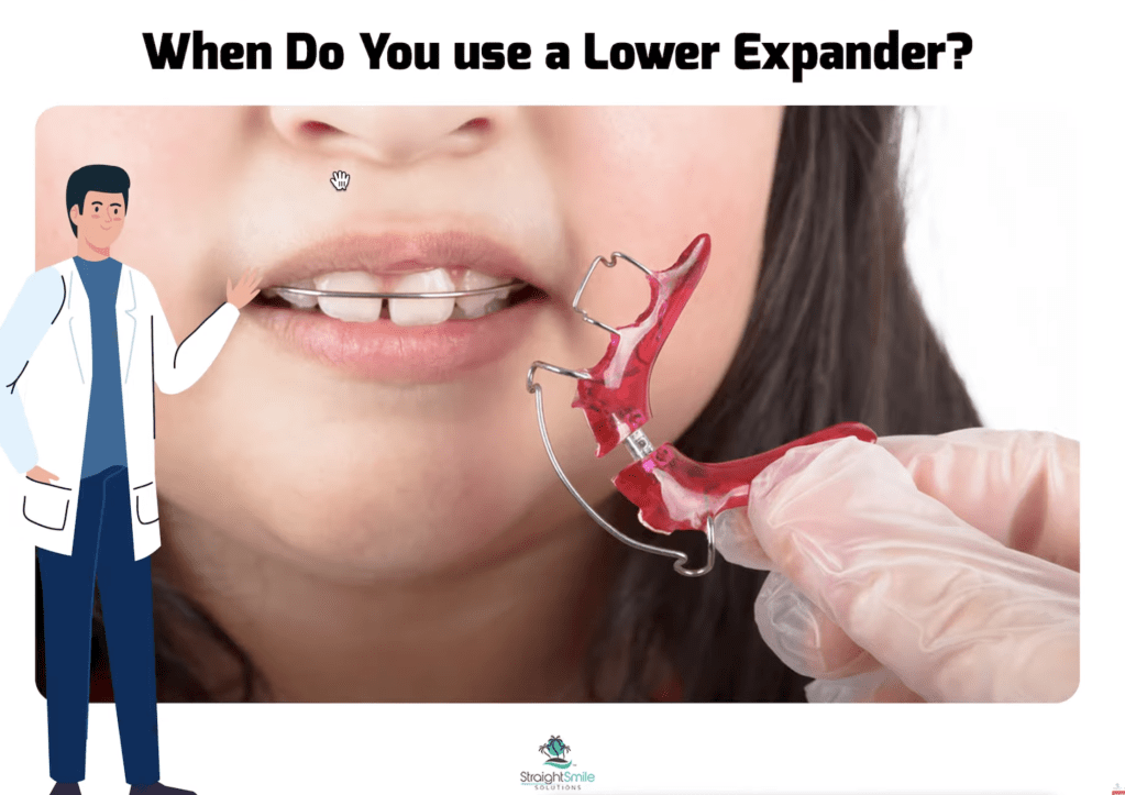 When Do You Use a Lower RPE / Expander?
