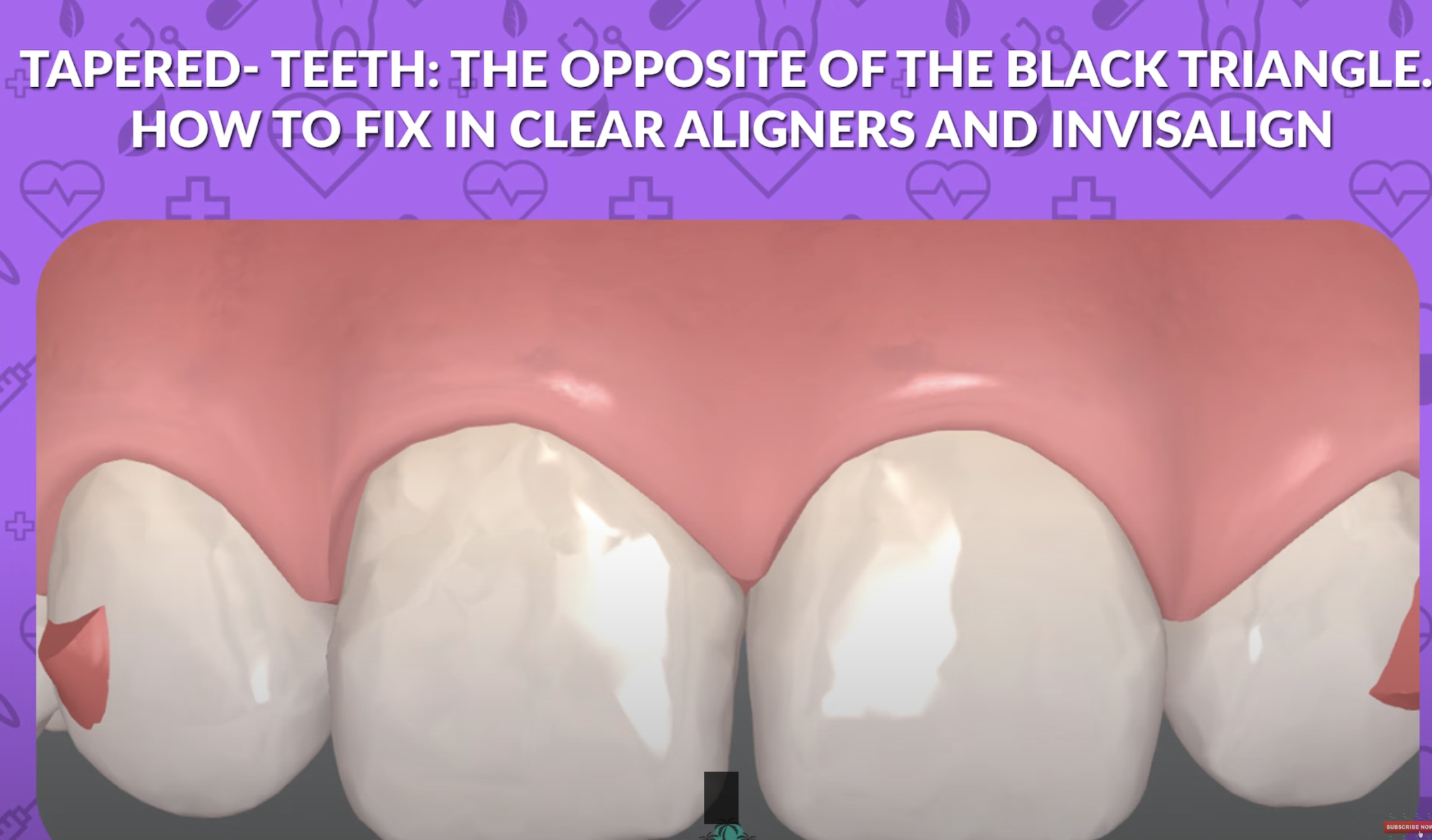 Addressing Tapered Teeth in ClinChecks