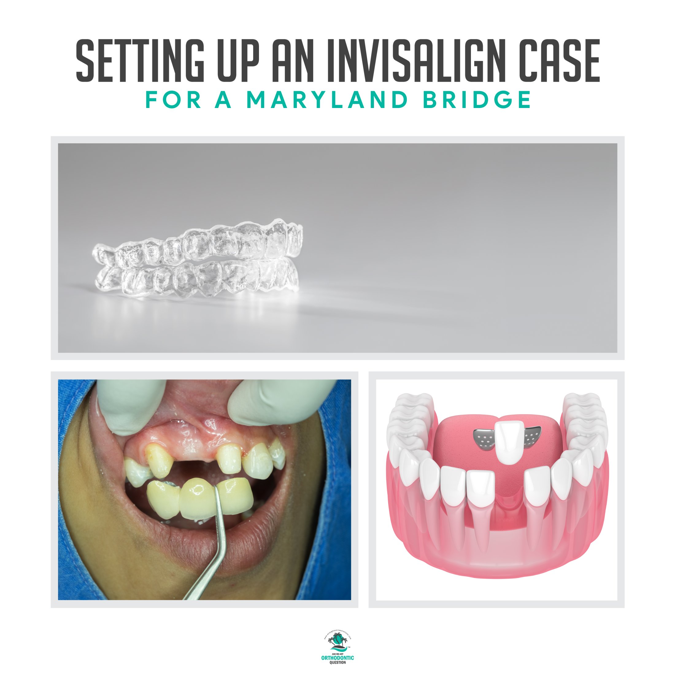 Addressing Maryland Bridges with Invisalign and Clear Aligners