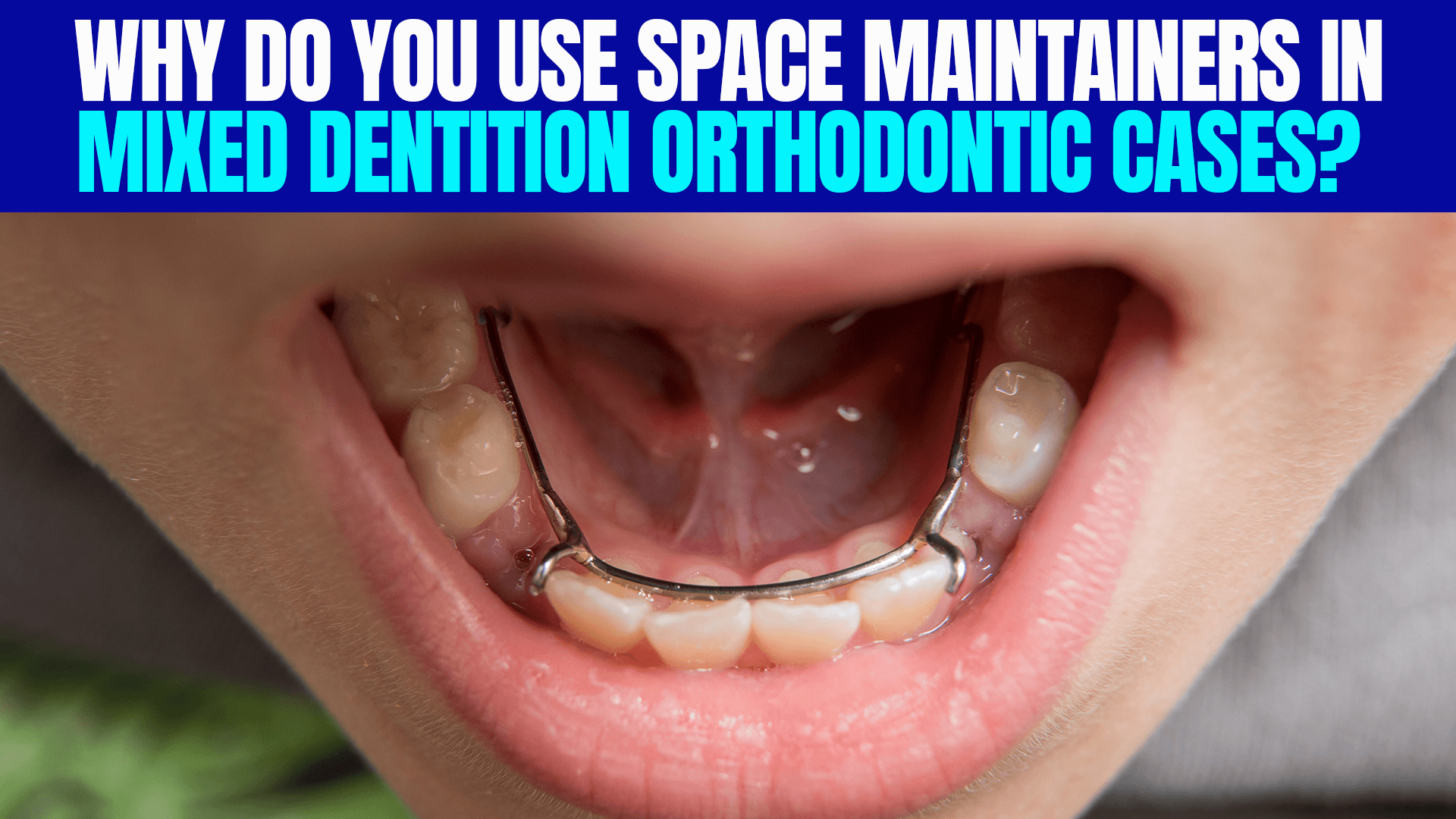 The Value of Space Maintainers for Mixed Dentition Orthodontic Cases?