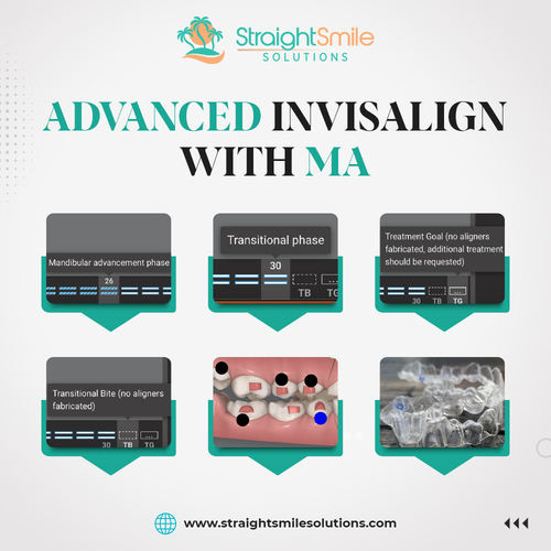 Advanced Invisalign with MA