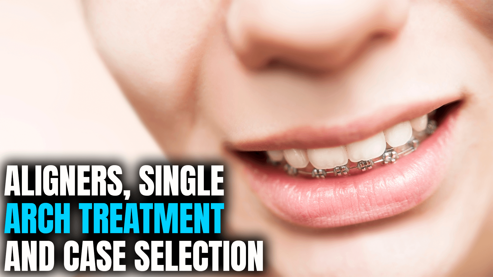 Attachmentless Aligners, Single Arch Treatments, and Using Them