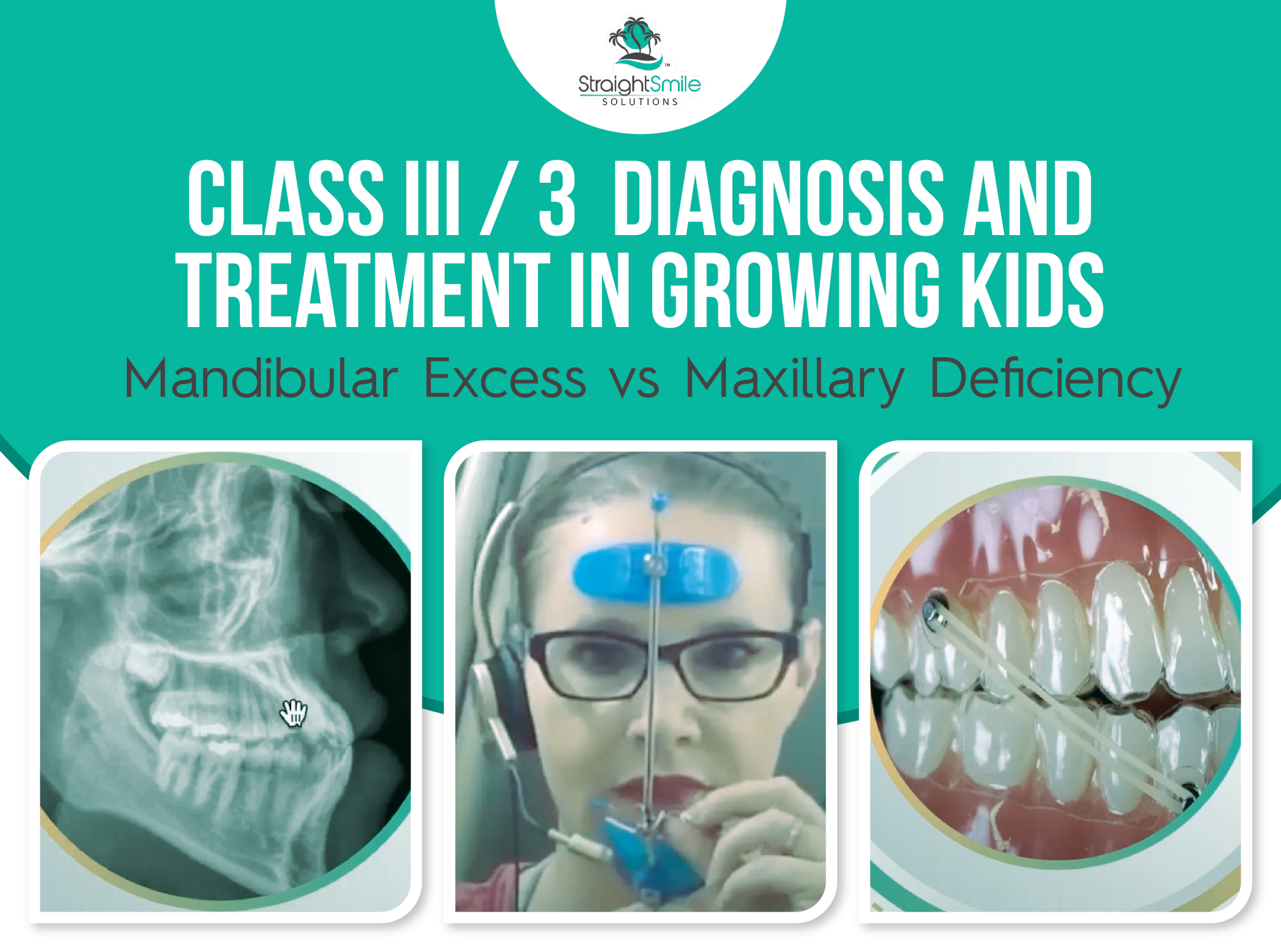 Identifying Growth Tendencies in Class III Growing Kids