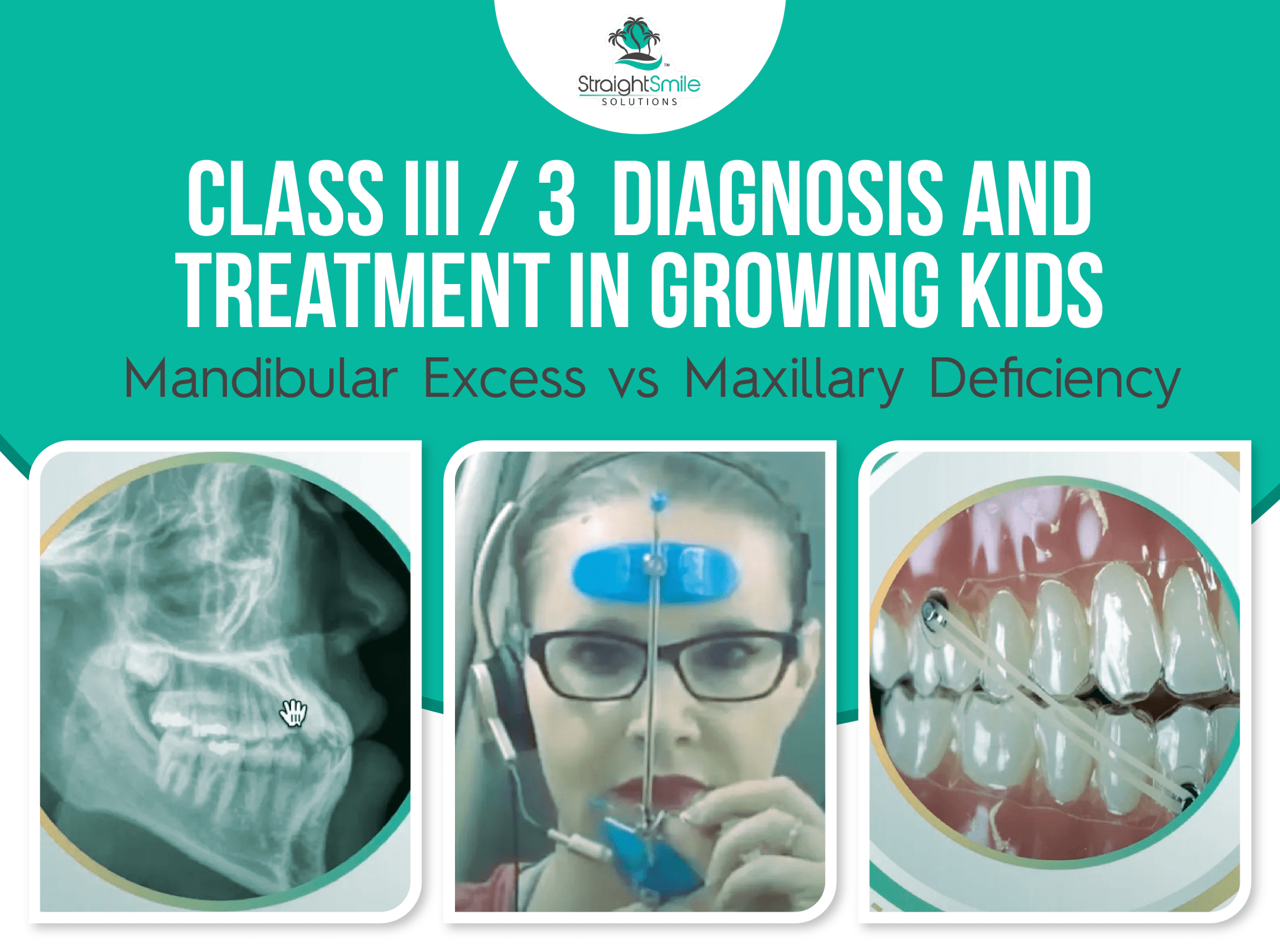 Identifying Growth Tendencies in Class III Growing Kids