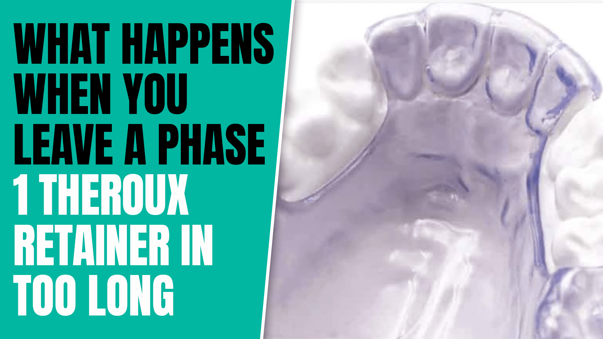Wearing a Theroux Retainer for Too Long
