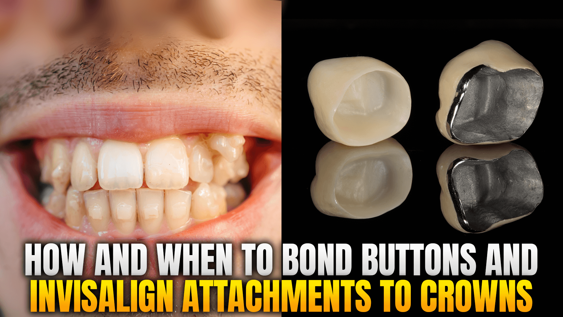 Bonding Buttons and Attachments to Crowns: What You Should Know