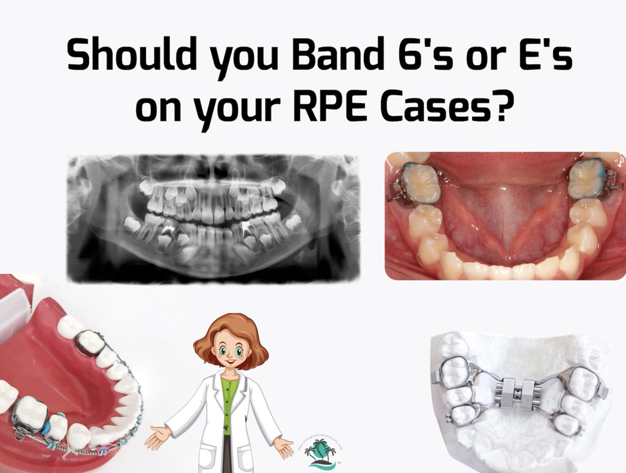 Should I Band Es or 6s in an RPE Case?