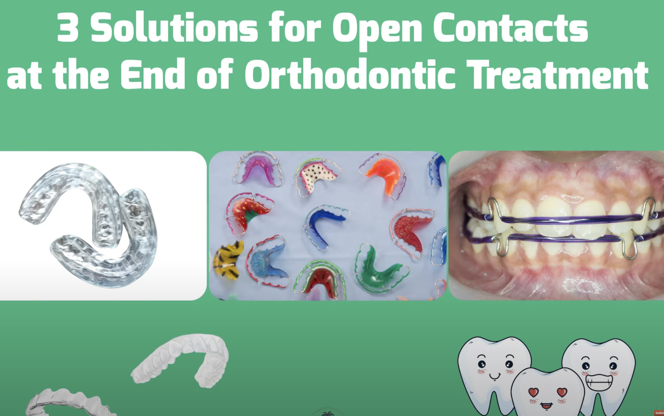 How to Close Open Contacts Posterior Spaces at the End of Invisalign ...