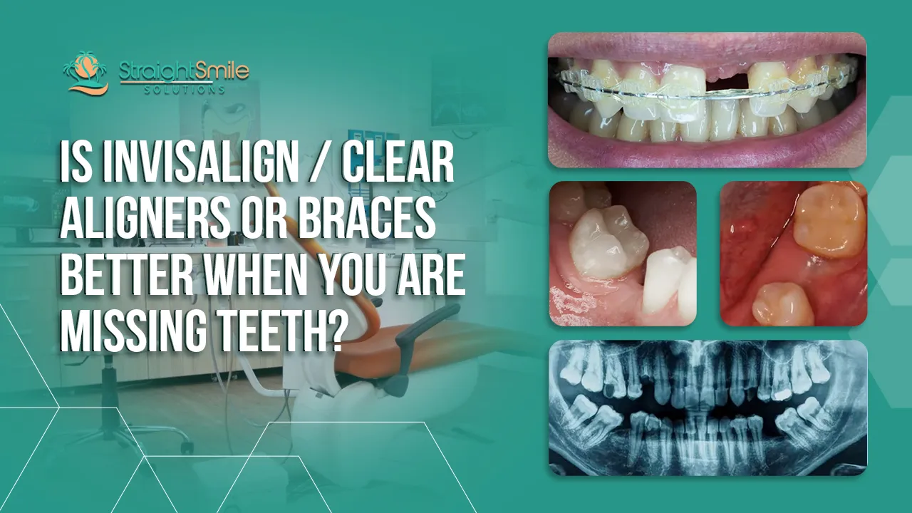 Missing Tooth Cases; Invisalign and Clear Aligners or Braces?