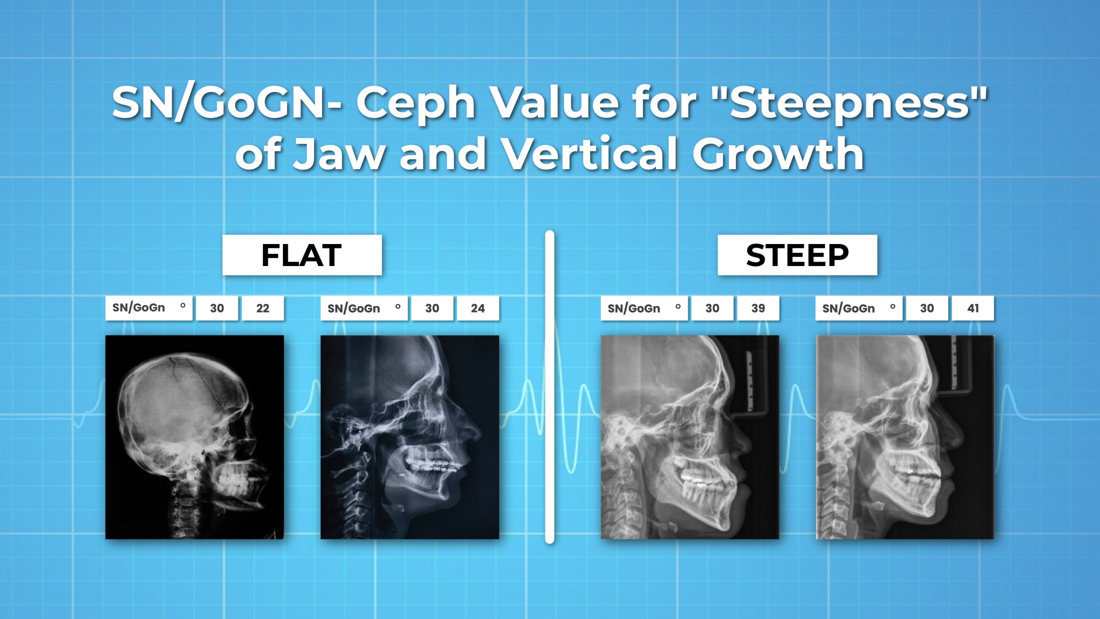 Understanding SN/GoGN (Mandibular Plane Angle) in CEPHs