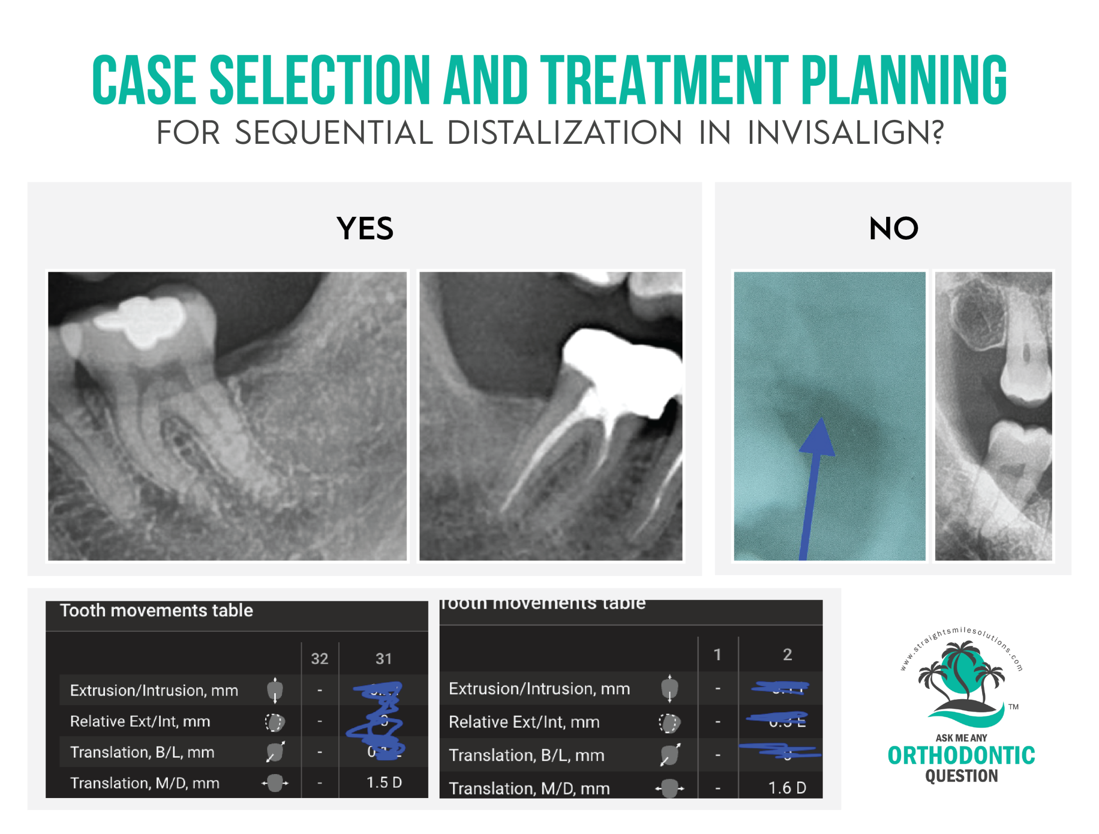 Treatment Planning for Sequential Distalization in Invisalign