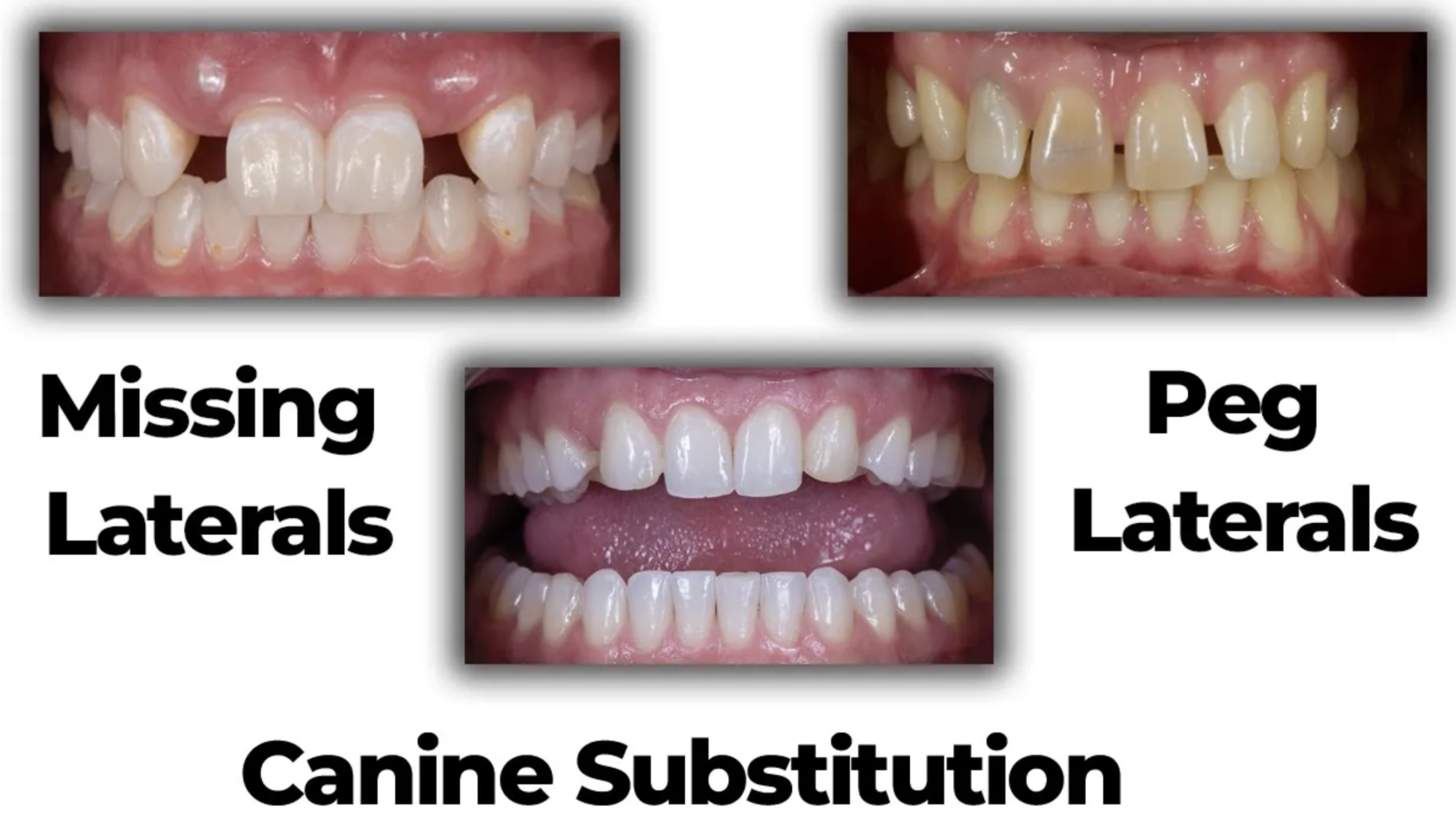 What You Need to Know About Missing Incisors and Canine Substitution in ...