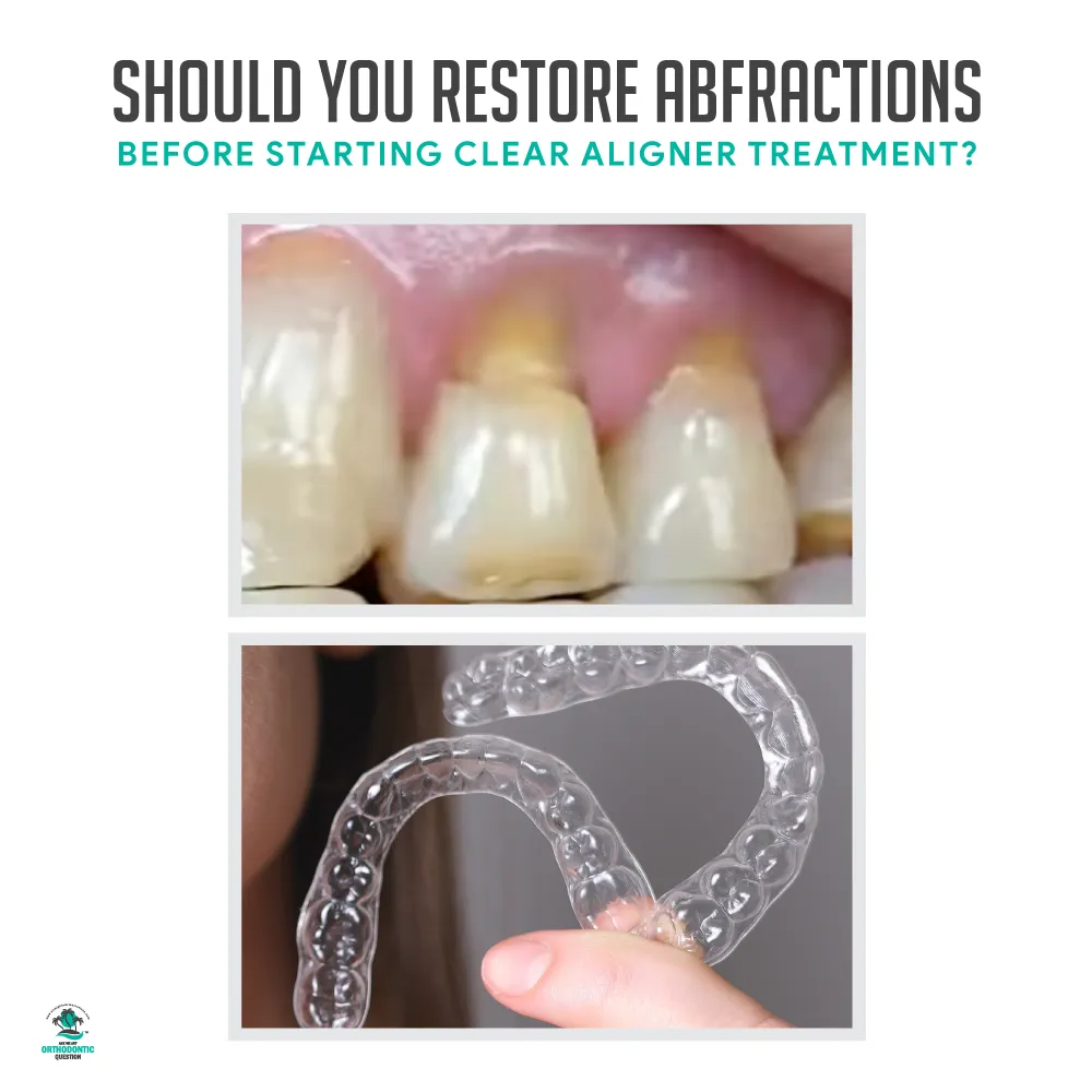 Should I Restore Abfractions Before Starting a Clear Aligner Treatment ...