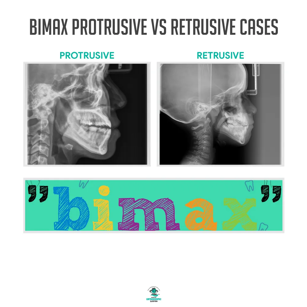 Bimax Protrusive and Bimax Retrusive Cases: What You Need to Know