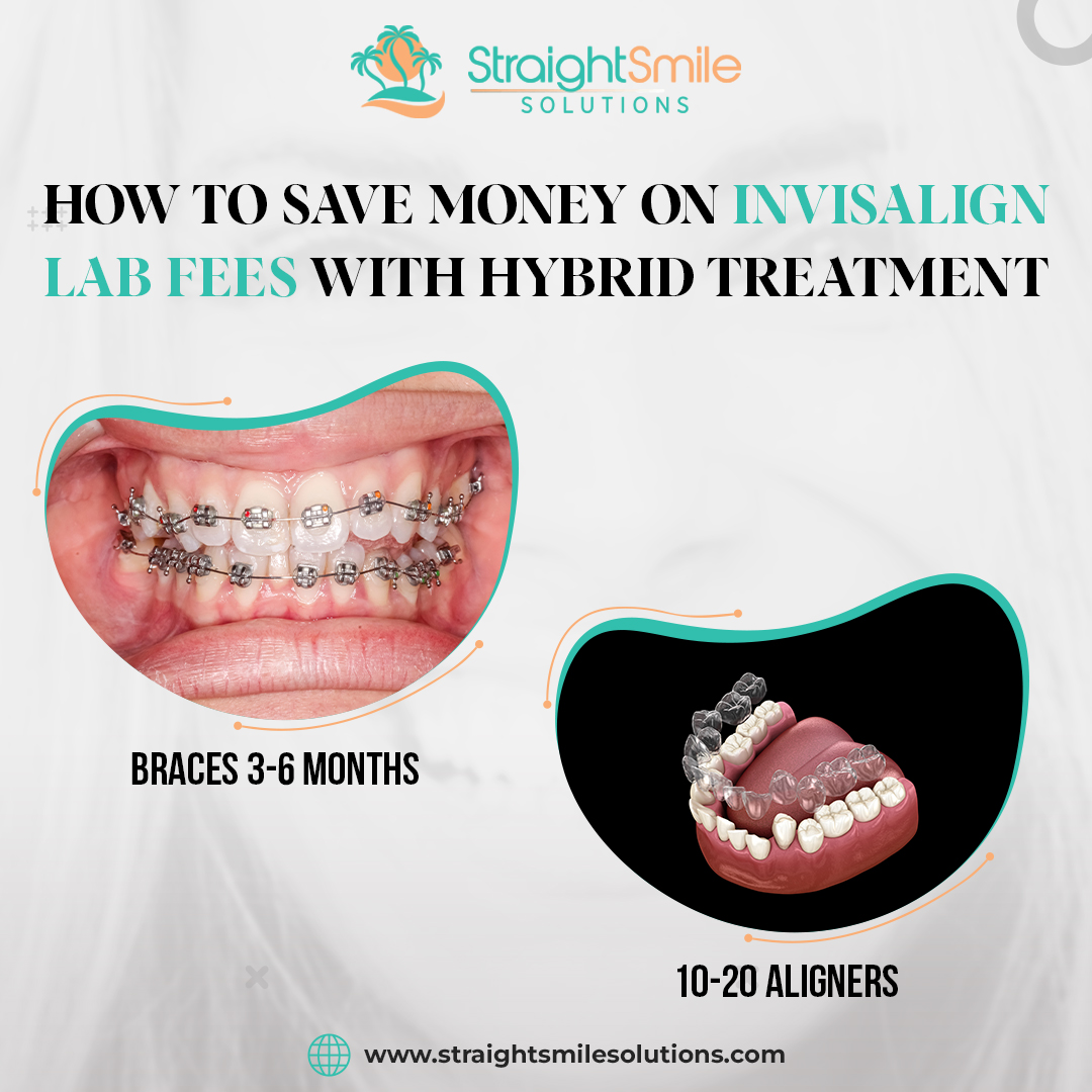 Using Hybrid Treatment to Reduce Invisalign / Ortho Lab Fees and Costs