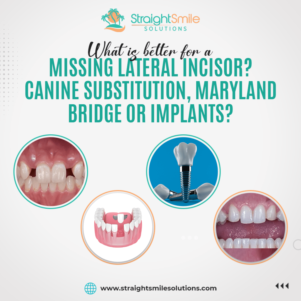 Best Restorative Options and Retention for a Missing Lateral Incisor ...