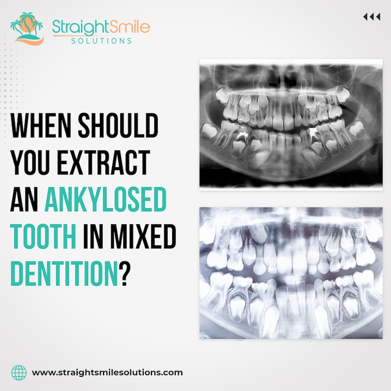 When Should Ankylosed Baby Teeth Be Extracted?