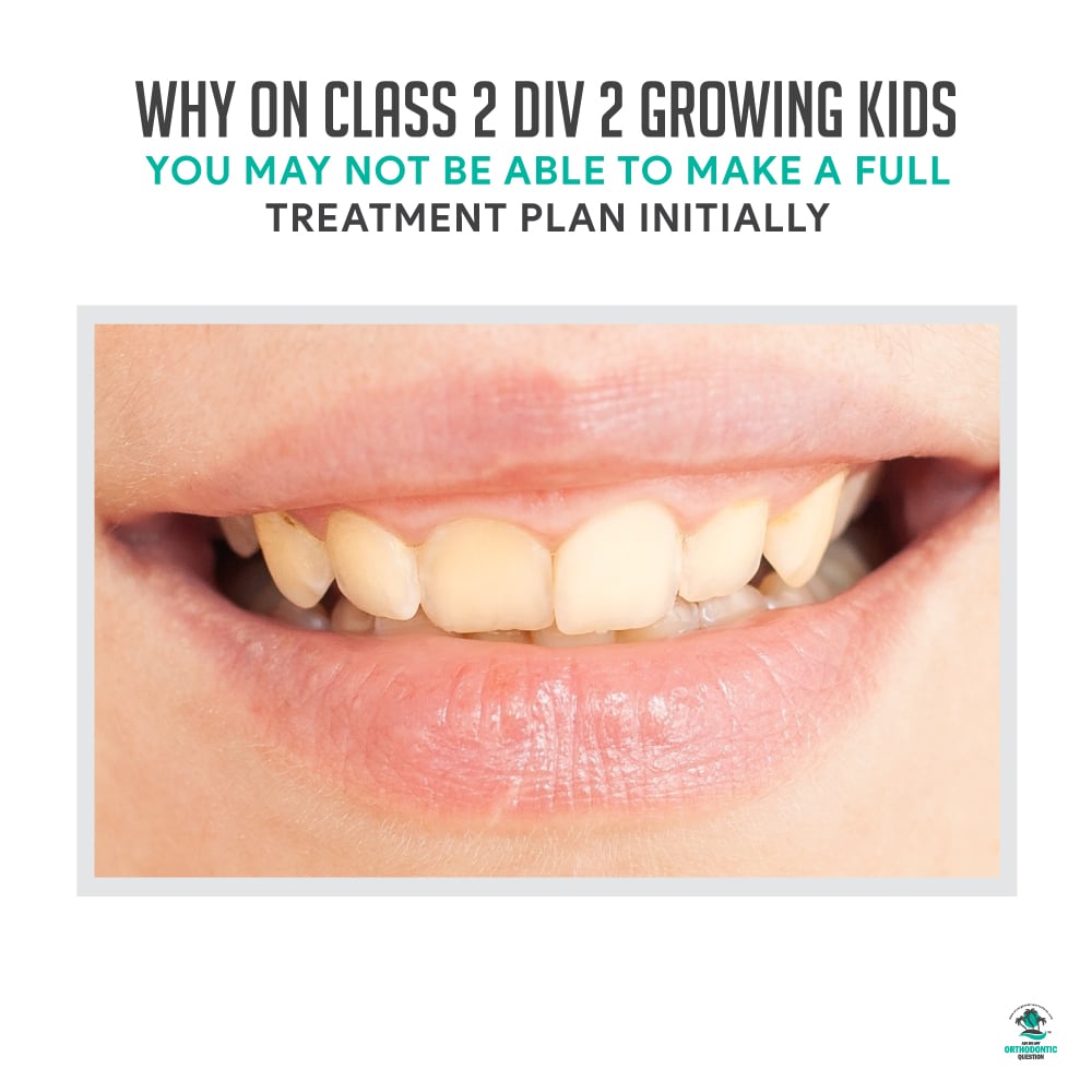 How to Treatment Plan Class II, Div II Growing Kids in Stages