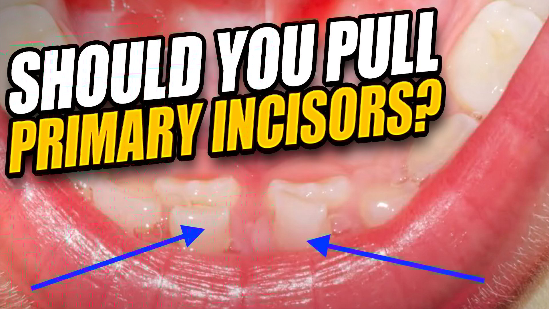 Should You Pull Baby Teeth Before Braces and Invisalign?