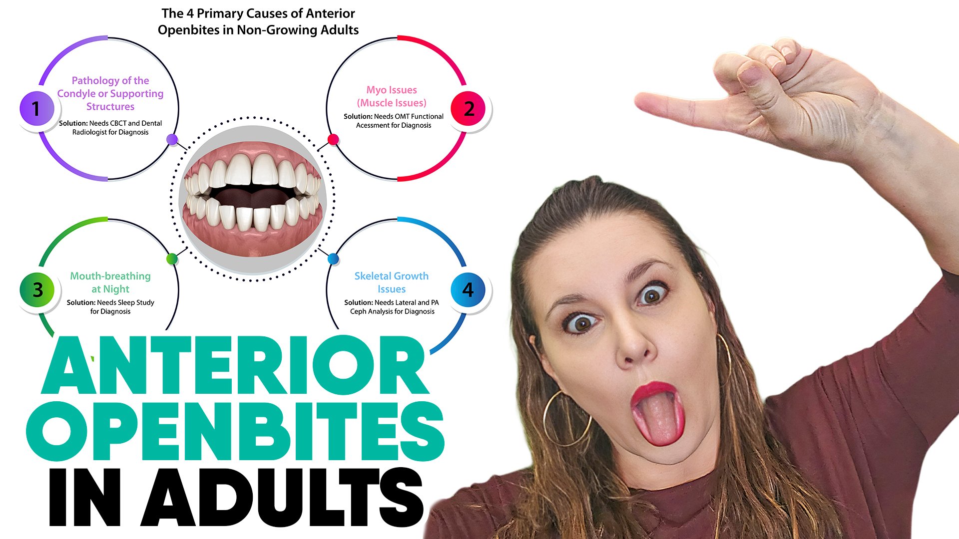Anterior Openbites in Non-Growing Patients