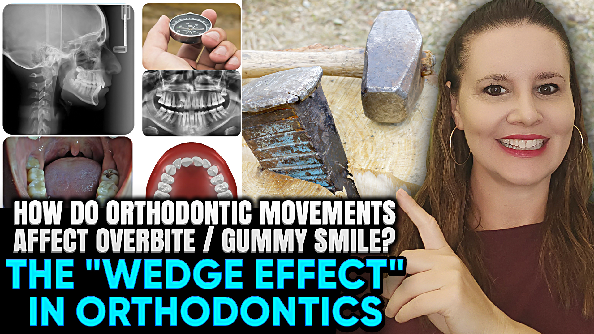 Overbite/ Overjet/ Gummy Smile and "The Wedge Effect" with Braces and ...