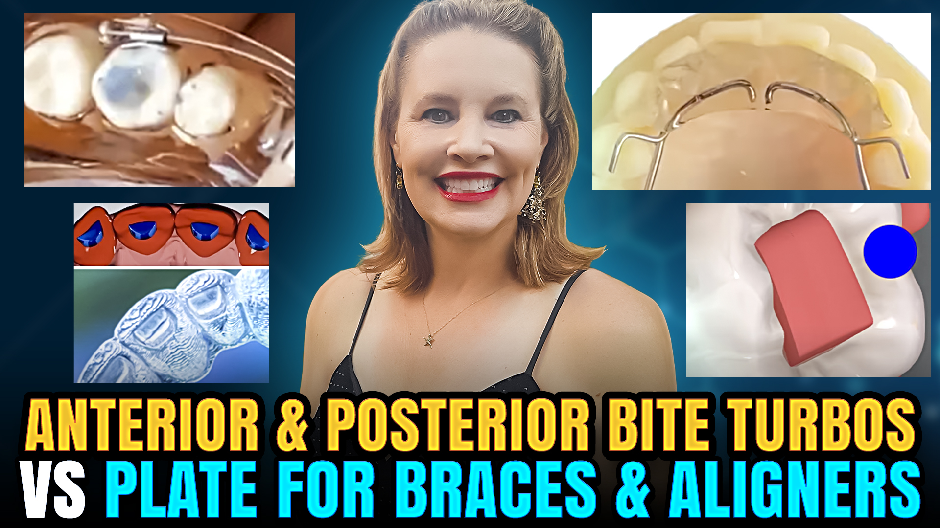Anterior and Posterior Bite turbos and Plates for Braces And Aligners