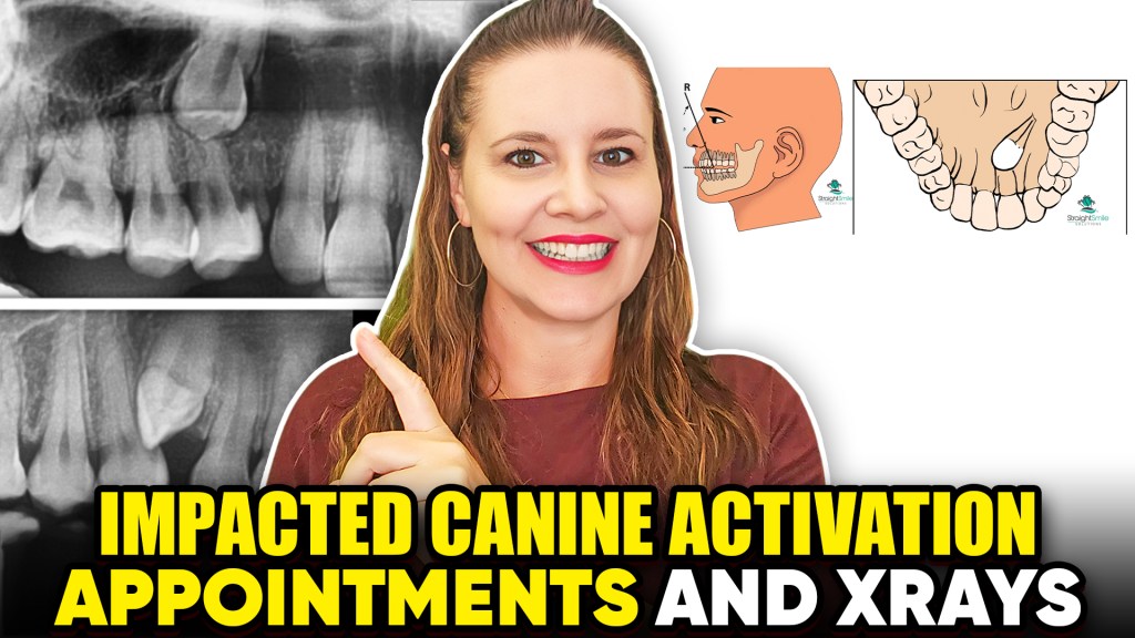 Impacted Canine with Braces: Steps, Appointments and Xrays