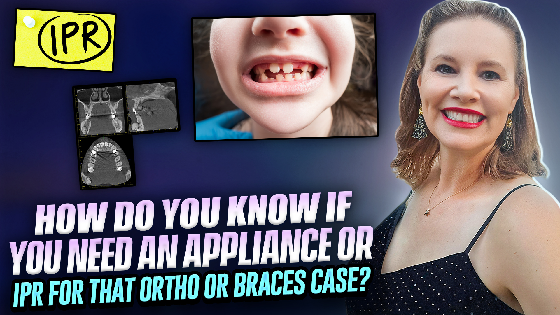 When to Add IPR Myo Appliances to that Aligner or Braces Case