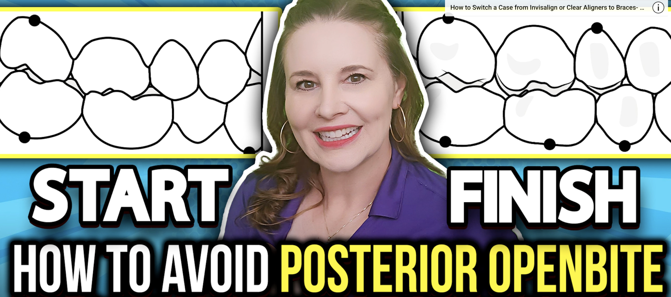 How to Avoid Posterior Open Bites (POB) with Posterior Crossbite Correction