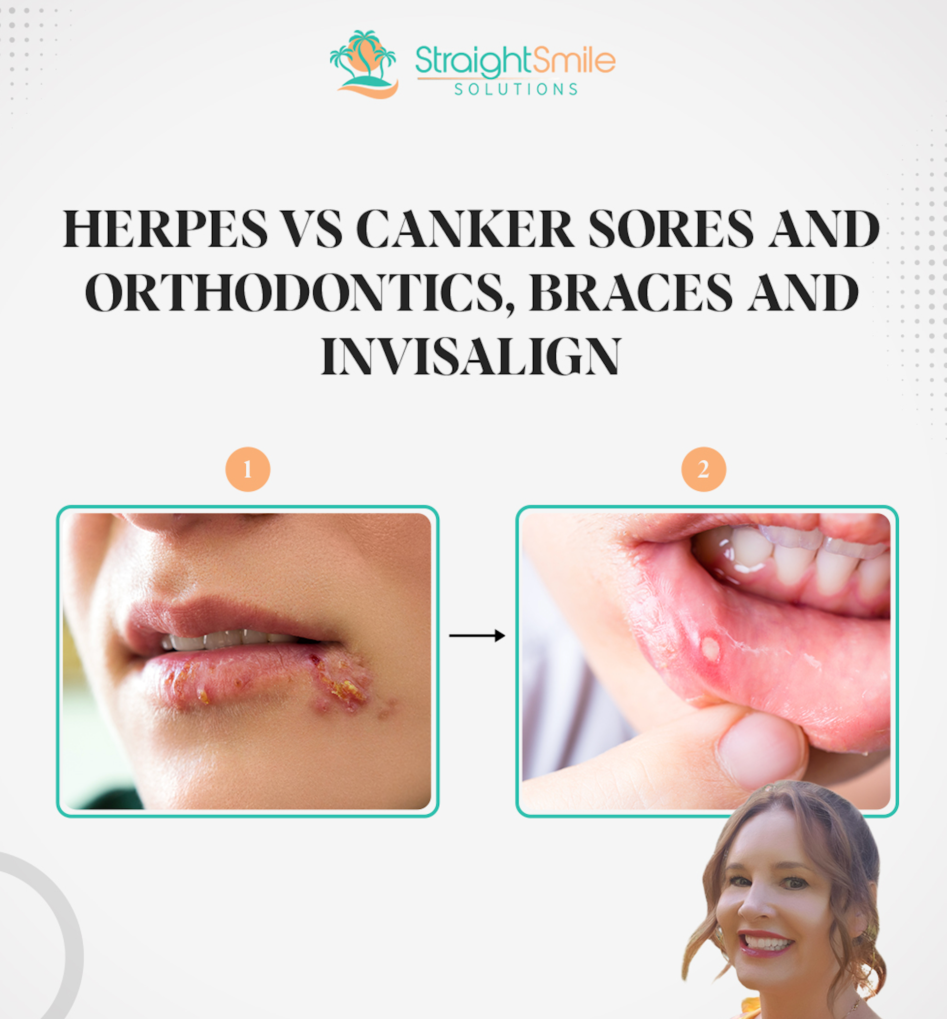Herpes vs Canker Sores in Orthodontics
