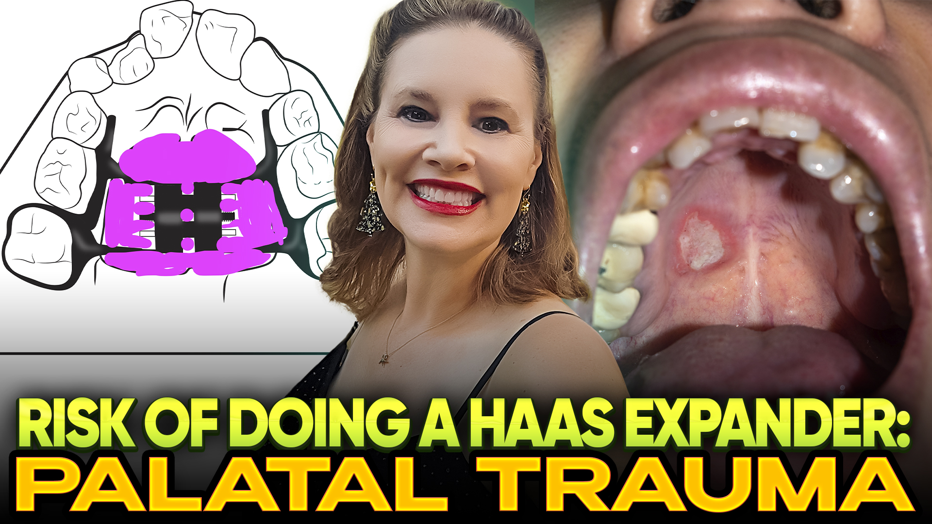 Risks of Using a Haas Expander Instead of IPE, RME, or RPE